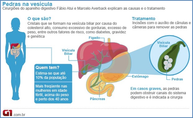 Vesícula Biliar Infográfico | Cirurgia de Hérnia e Vesícula Biliar em ...